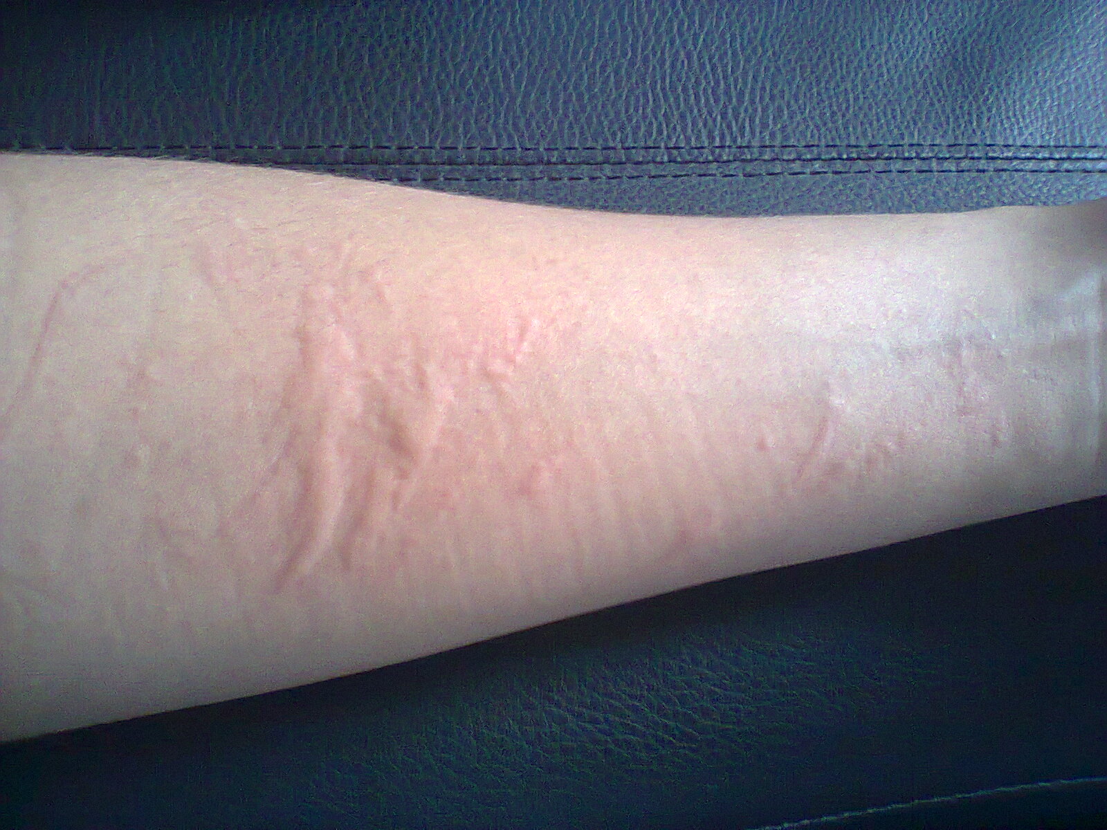 La dermografía como parte de mi vida.